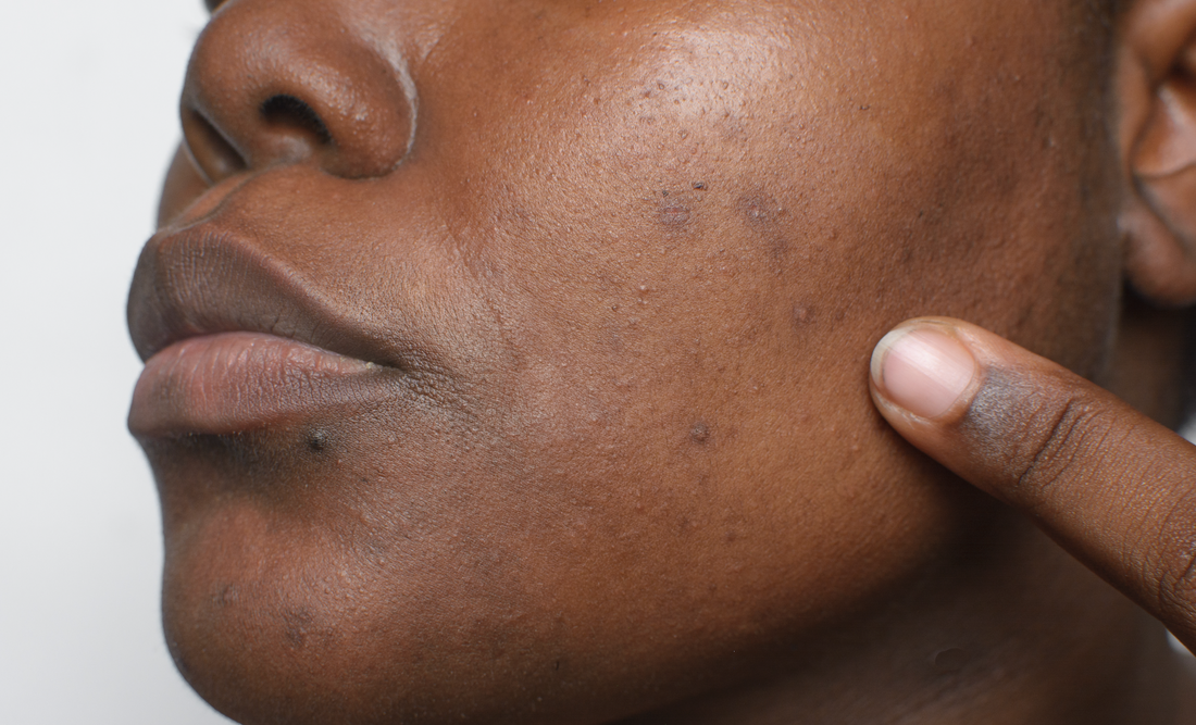 How To Clear Acne Scars Fast Gin Amber Beauty