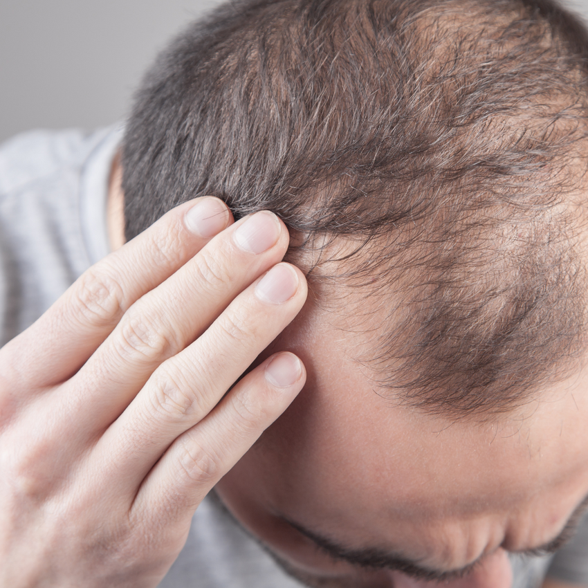 How to Reverse Balding Using a Dermaroller – Gin Amber Beauty
